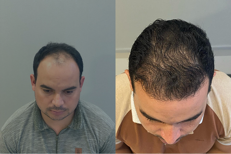 Especialista em Transplante Capilar Robótico - Clínica Robótica Capilar